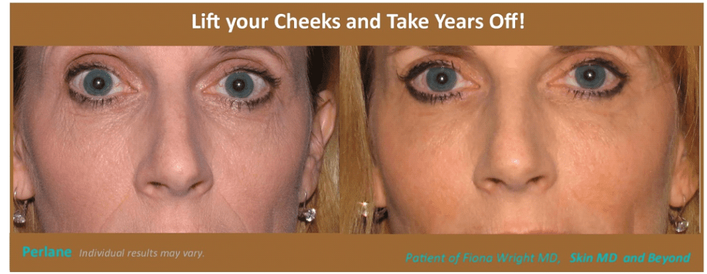 Cheek Rejuvenation Plano TX - Non-Surgical Cheek Lift Frisco TX