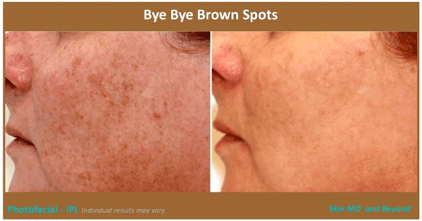 Age Spots Plano, TX | Brown Spots Frisco, TX | Age Spots Removal