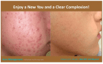 Acne Treatment Plano TX - Skin Blemish Treatment Frisco TX