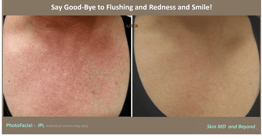 Cheek Rejuvenation Plano TX | Skin MD & Beyond