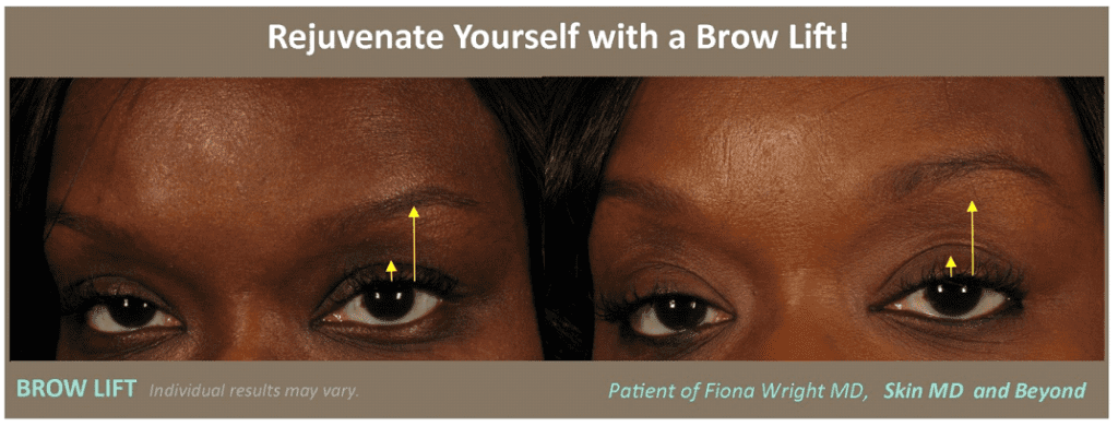 Eyebrow Droop Plano TX - Brow Lift Treatment Frisco TX