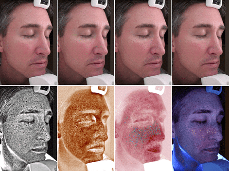 VISIA Comprehensive Complexion Plano TX - Facial Analysis