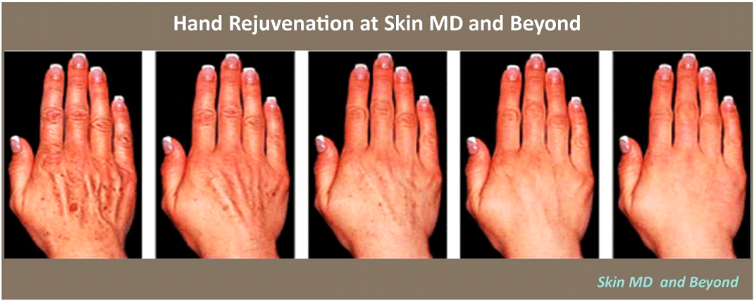 Hand Rejuvenation Plano TX - Photo Rejuvenation Frisco TX