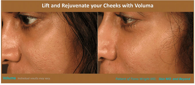 Cheeks | Interactive Body Guide | Skin MD and Beyond