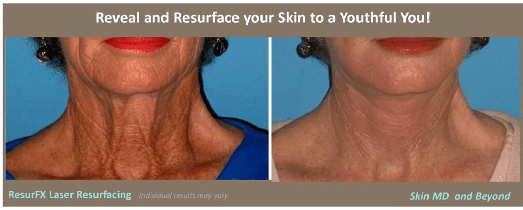 Neck Rejuvenation – BROWN SPOTS and AGE SPOTS - Cosmetic Skin Care ...