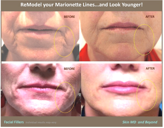 Marionette Lines After Lip Filler - Infoupdate.org