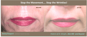 Lip Lines/Borders Plano TX - Lip Enhancement Frisco TX