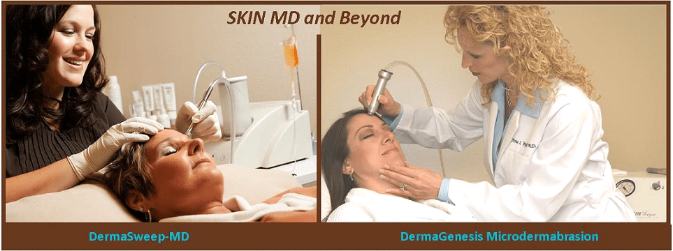 Microdermabrasion in Plano, TX | DermaSweep Frisco, TX