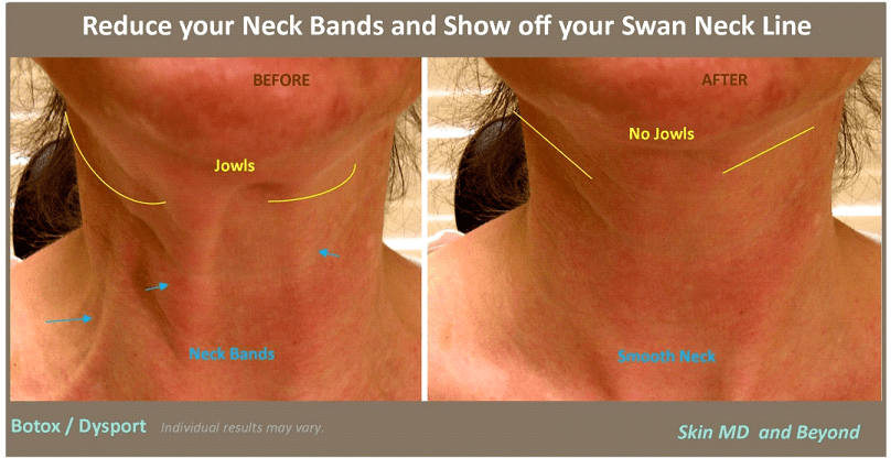 Neck Rejuvenation Plano TX | Skin Tightening Frisco TX | Neck Tightening