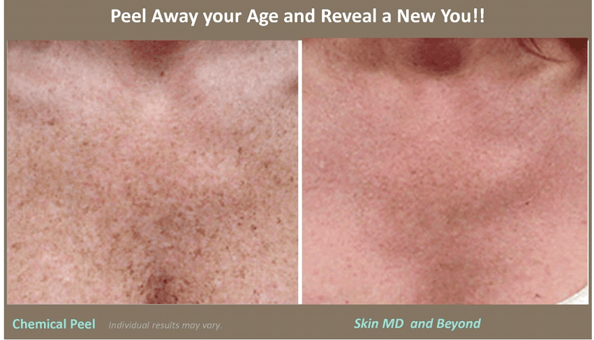 Neck Rejuvenation – BROWN SPOTS and AGE SPOTS - Cosmetic Skin Care ...