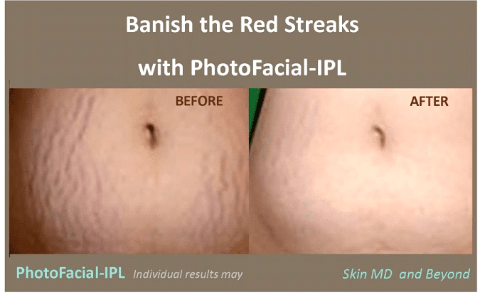 Stretch Marks - Cosmetic Skin Care Specialist Plano, TX