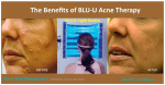 Acne Treatment Plano TX - Skin Blemish Treatment Frisco TX