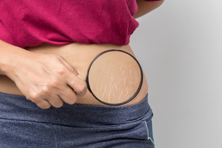How to Correct & Erase Stretch Marks - Cosmetic Skin Care Specialist
