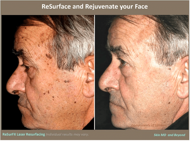 LASER RESURFACING and TIGHTENING - Cosmetic Skin Care Specialist Plano, TX