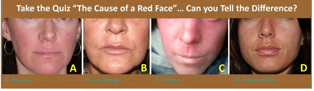 Red Face Treatments Plano TX - Flushing & Blood Vessels Frisco