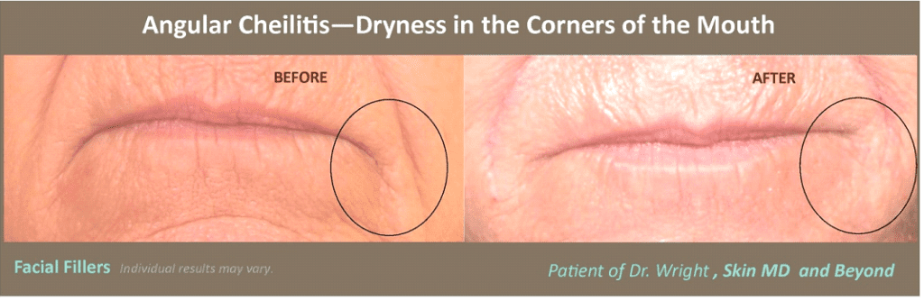 Dry, Rough Lips Treatment Plano TX - Lip Rejuvenation Frisco TX