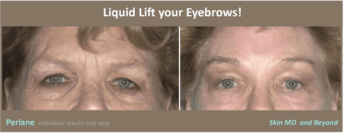 Perlane Treatment in Plano, TX | Skin MD & Beyond