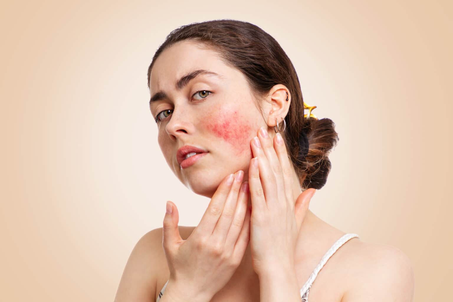 Understanding and Managing Rosacea - Plano, Texas