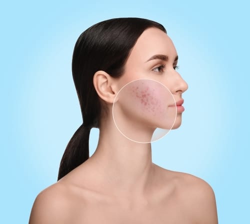Understanding Blu-U Therapy: How It Treats Acne - Cosmetic Skin Care ...