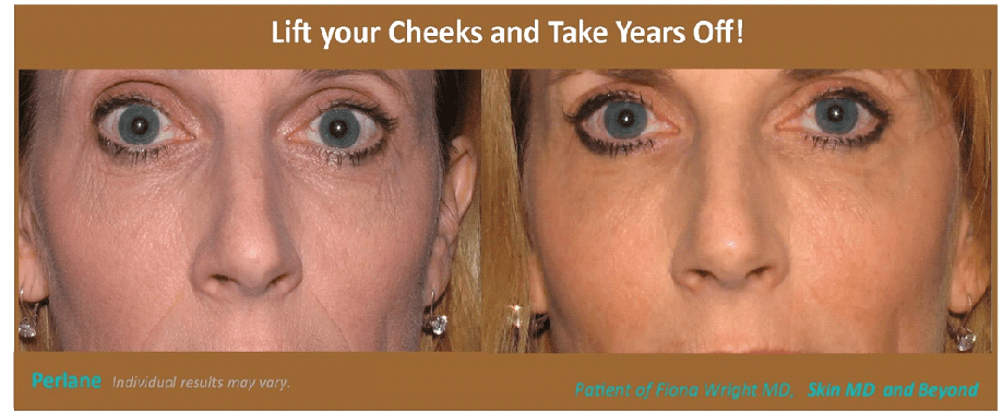 Cheeks | Interactive Body Guide | Skin MD and Beyond