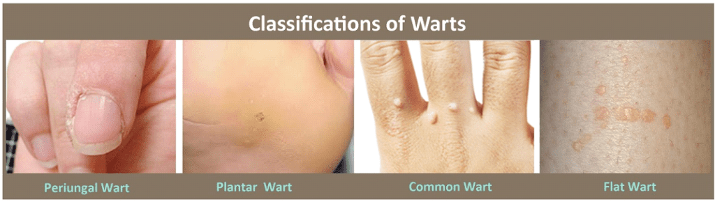 Wart Treatment Plano TX - Warts Removal Frisco TX